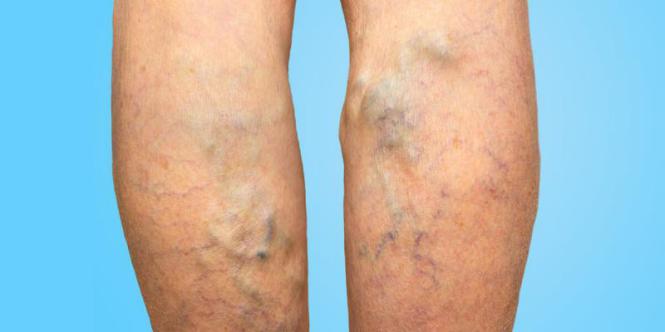 Compare o preço de Varicoss 15 90 Mg Com 20 Drageas nas melhores farmácias