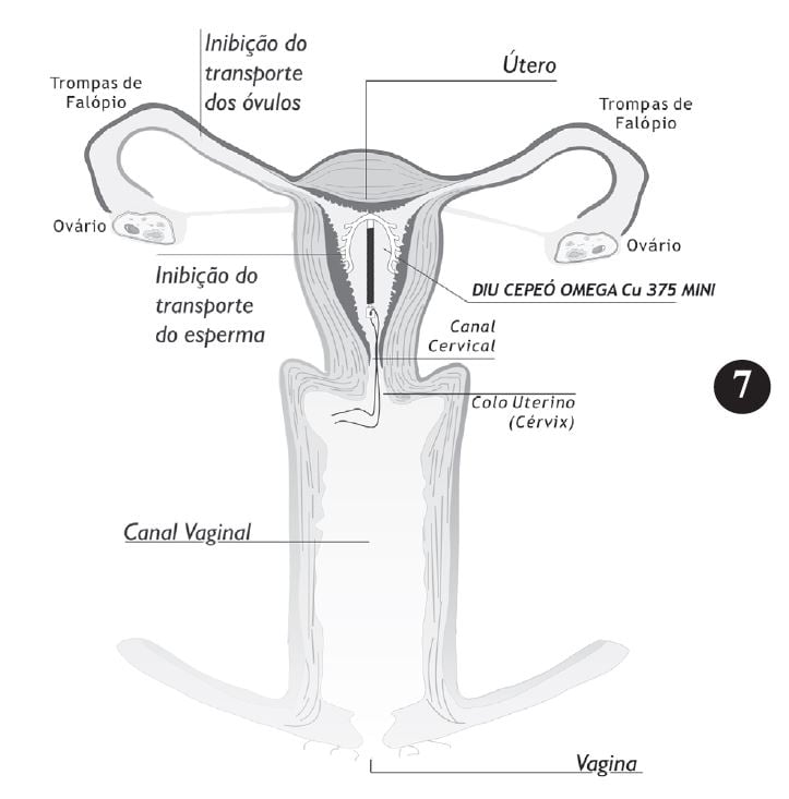 Dispositivo Intrauterino(DIU) Cepeó Omega CU375 Mini - Dispositivo ...